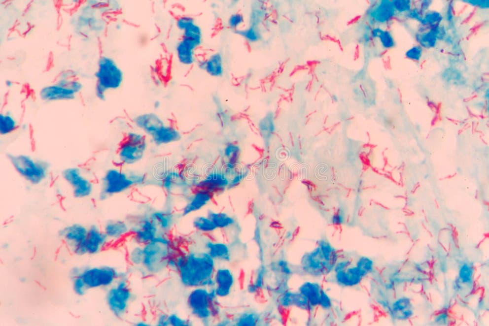 Mycobacterium tuberculosis stock image. Image of lung - 80362181