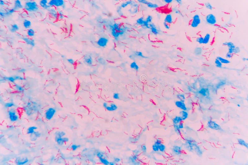 Mycobacterium tuberculosis stock image. Image of infection - 80362273