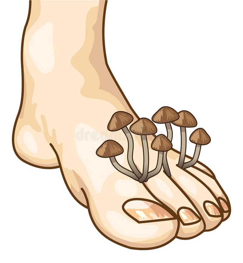 Mycosis between the toes. stock vector. Illustration of close - 17993392