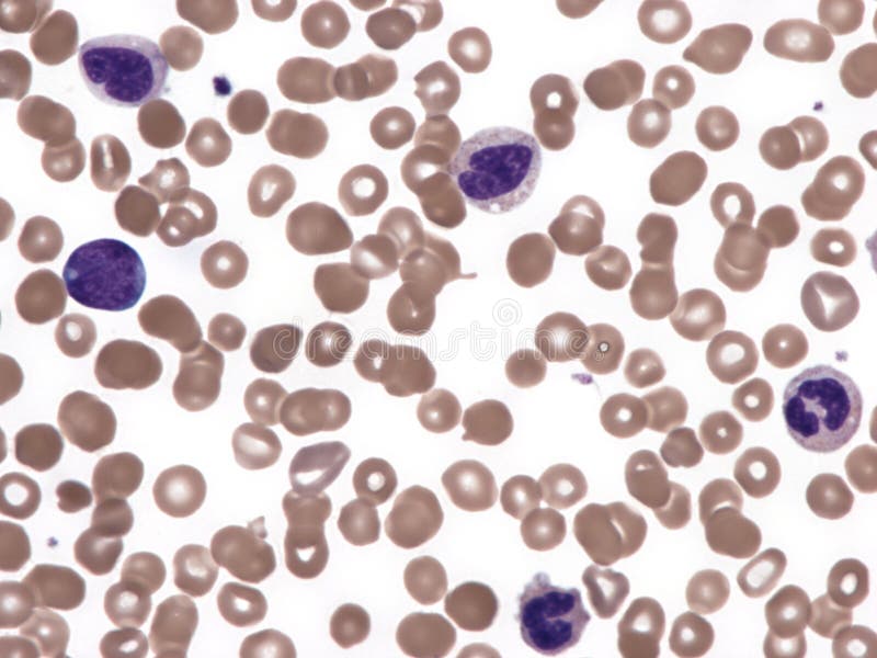 Myelodysplastic Myeloproliferative Neoplasm with Neutrophilia. Stock ...