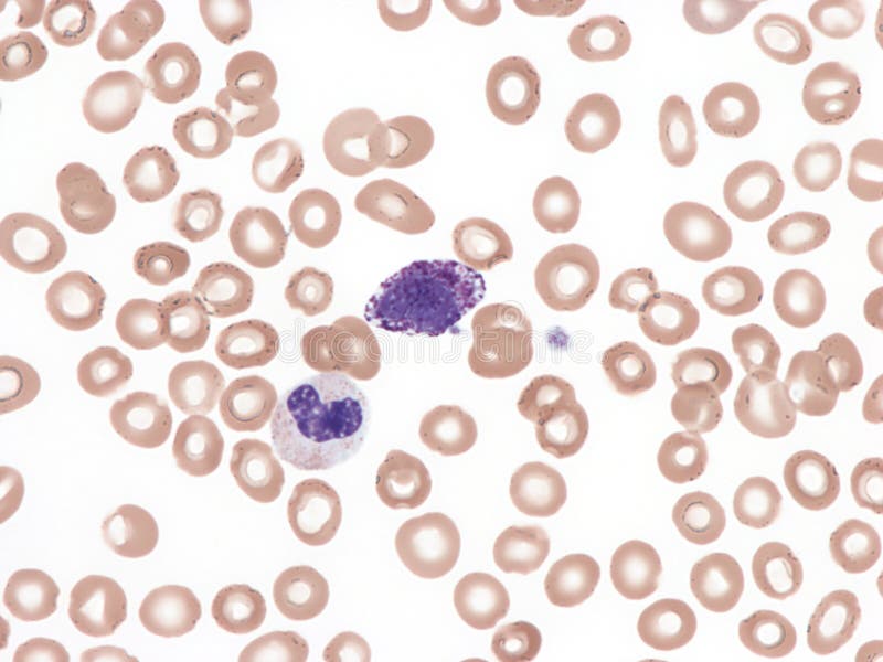 Neutrophil and Basophil in Myelodysplastic Syndrome. Stock Photo ...