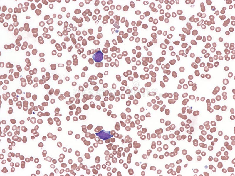Myeloid Blast Cells in Peripheral Blood. Stock Photo - Image of ...