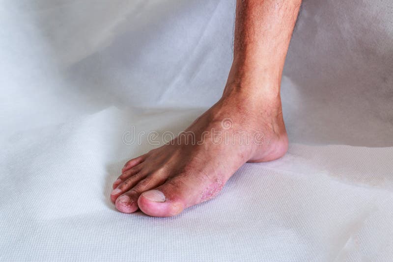 Mykose Des Bereichs Zwischen Den Zehen Stockbild - Bild von ...