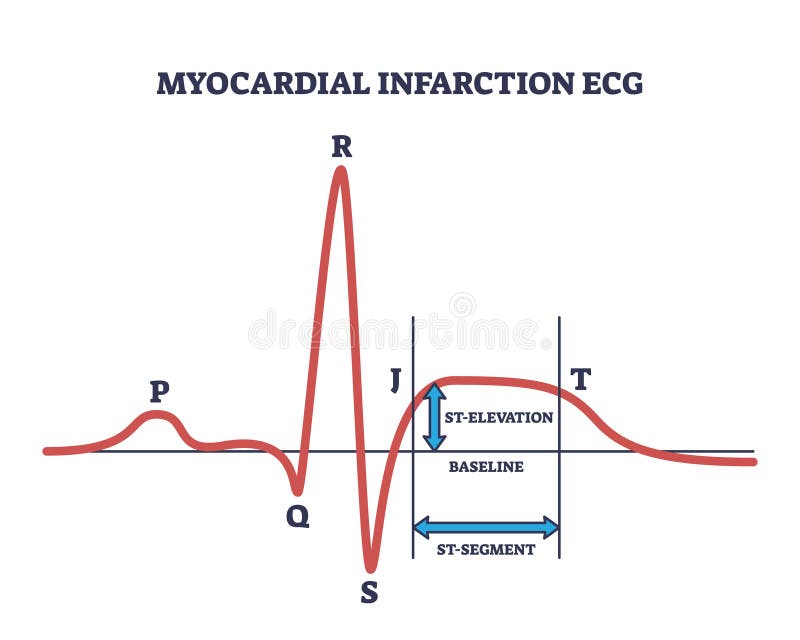 Acute Mi Ecg Tracing