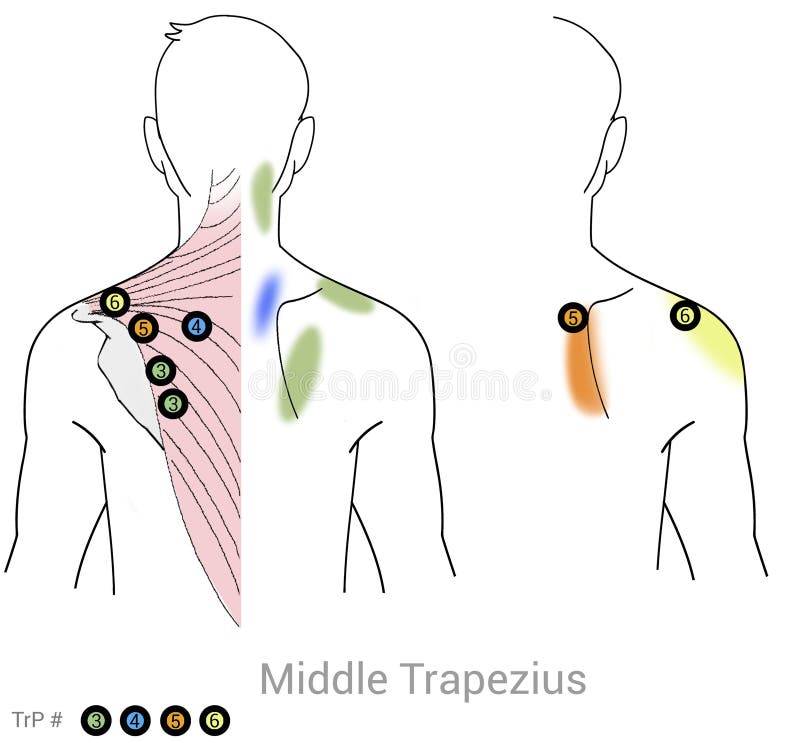 Upper Trapezius: Managing Pain Arriving from Myofascial Trigger Points ...