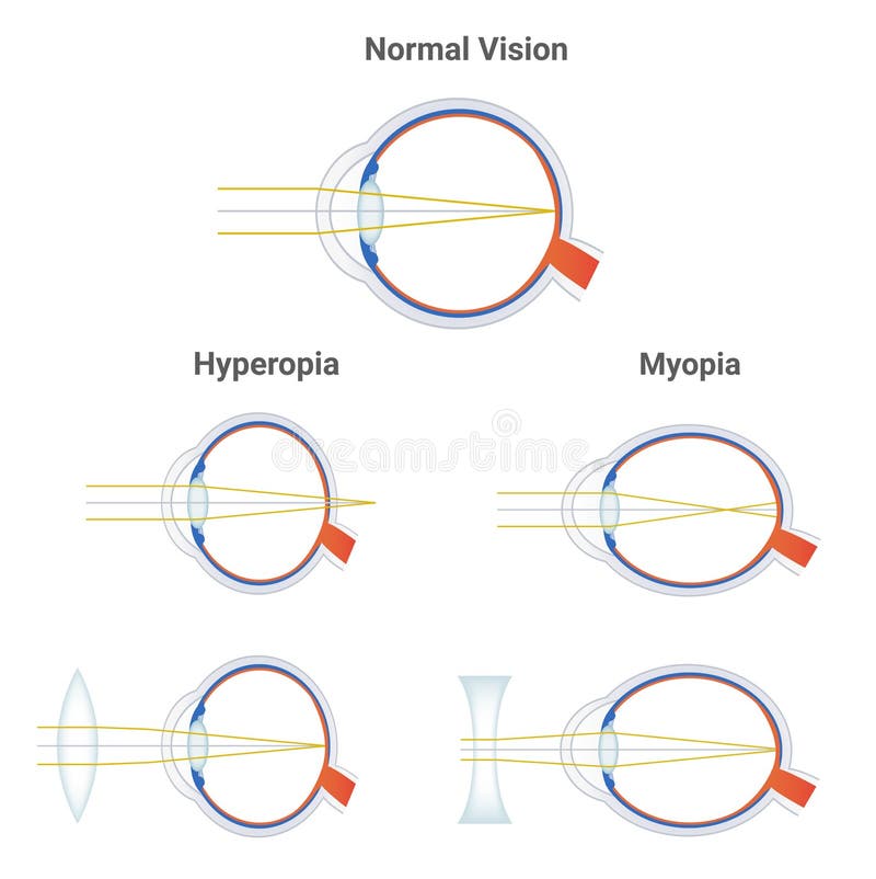 Myopia, Hyperopia, Normal Vision. Short Sightedness, Far Sightedness ...