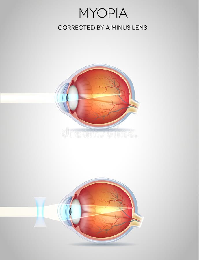 Myopia Stock Illustrations – 5,484 Myopia Stock Illustrations, Vectors ...