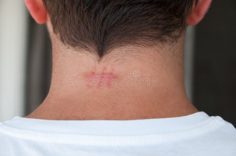 Narbe #3 stockfoto. Bild von medizinisch, stahl, medizin - 1373292