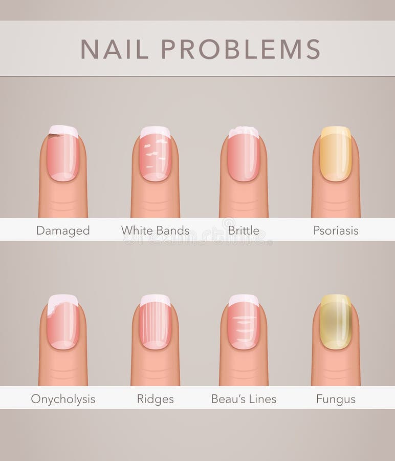 Nail Problems and Illness, Vector Poster Stock Vector - Illustration of ...