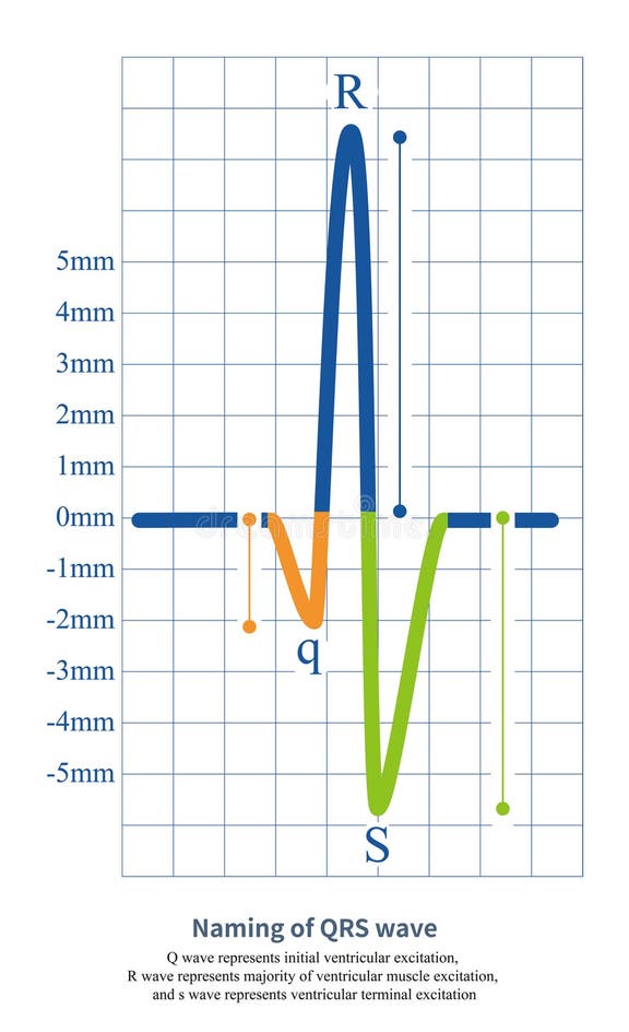 Naming of QRS wave stock photo. Image of right, arrhythmia - 343860076