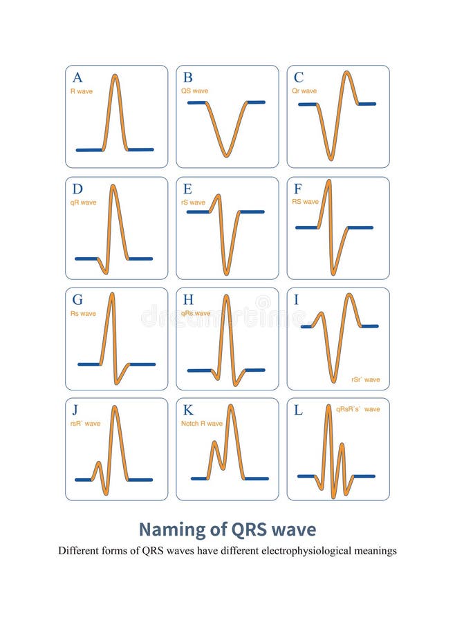 Naming of QRS wave stock illustration. Illustration of left - 343865975