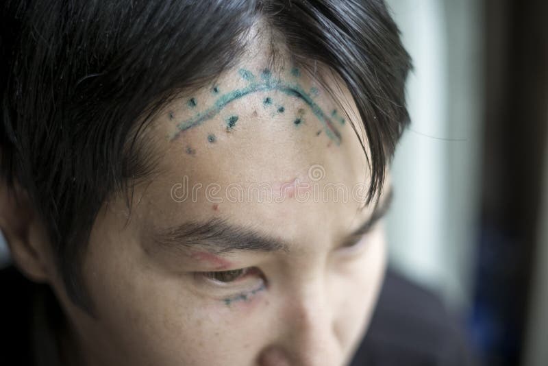 Narbe auf dem Kopf stockfoto. Bild von medizin, asiatisch - 86666936