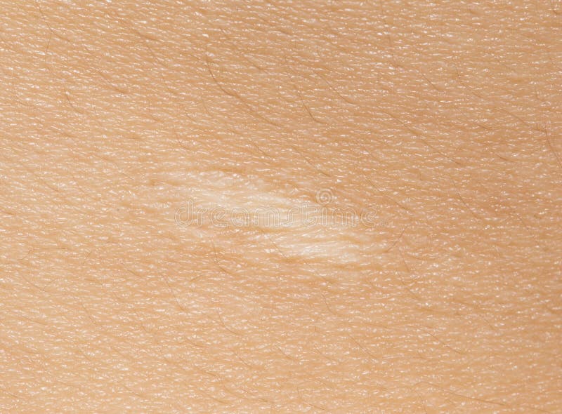 Narbe auf der Haut Makro stockbild. Bild von markierung - 93795363