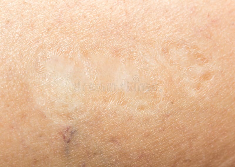 Narbe Auf Der Menschlichen Haut Stockfoto - Bild von falsch, bedrängnis ...