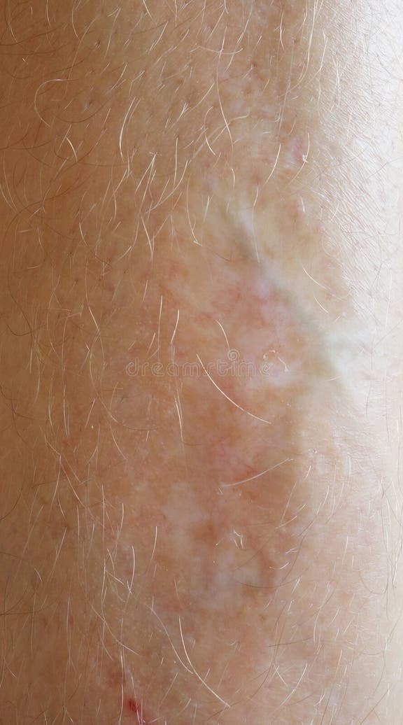 Narbe auf Haut stockfoto. Bild von verbogen, medizin - 46166410