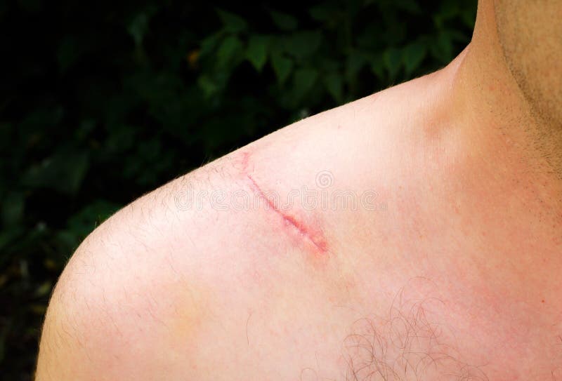 Narbe stockfoto. Bild von heftung, recover, heal, wiederanlauf - 8539172