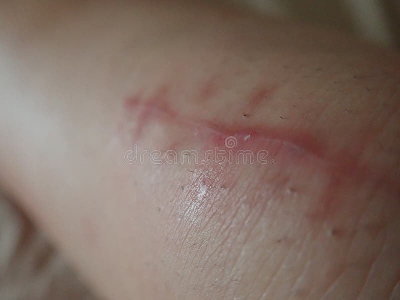 Narbe Nach Operation am Bein Stockbild - Bild von ästhetisch, medizin ...