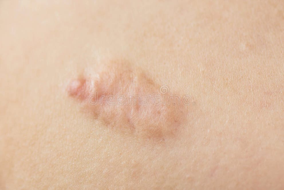 Narben auf der Haut stockbild. Bild von narbe, menschlich - 60409403