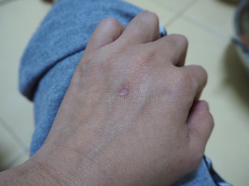 Hand Mit Narben Und Handschellen Auf Grauem Hintergrund Stockfoto ...