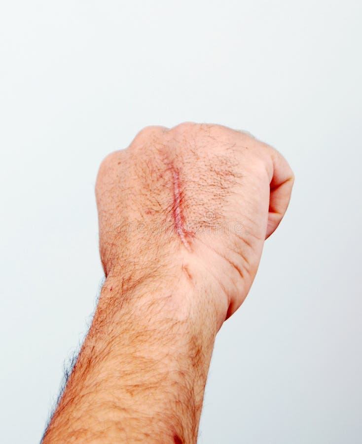 Die Hand mit der Narbe stockfoto. Bild von narbe, hand - 170800680
