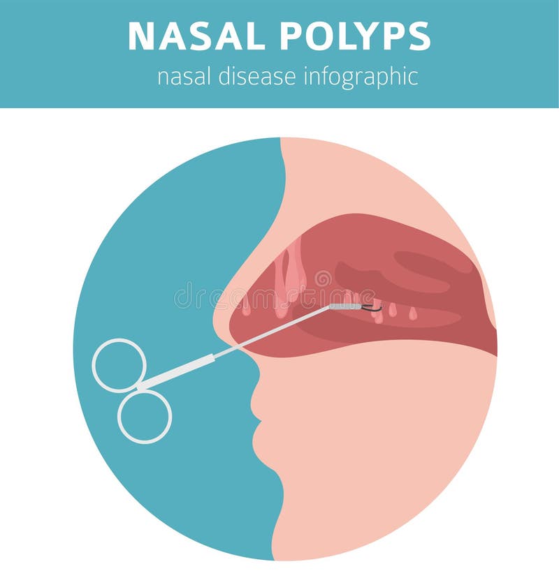 Nasal Diseases Nasal Polyps Causes Diagnosis And Treatment Medical