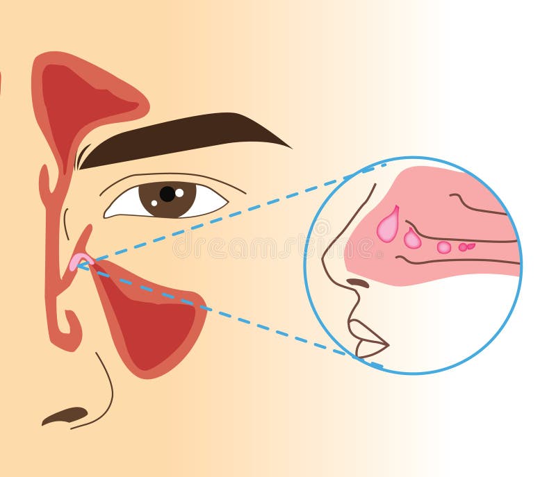 Nasal Polyp Section In Human Illustration Close Up Stock Illustration