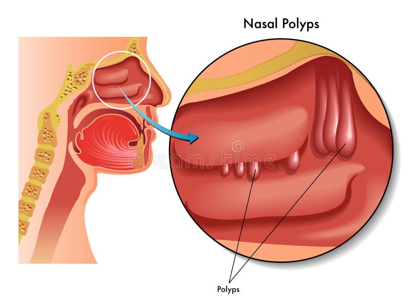 Nasal Polyps Stock Vector Illustration Of Mucus Gelatinous 36089678