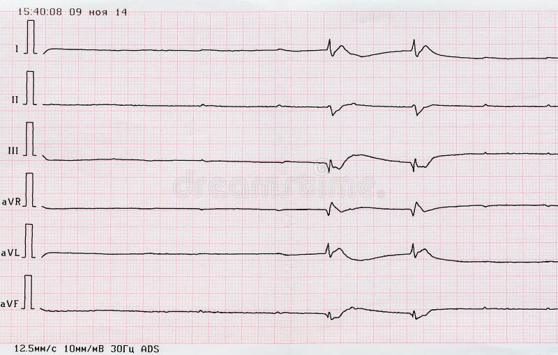 Cuore Sano Del Cardiogramma Illustrazione di Stock - Illustrazione di ...