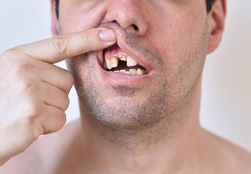 Portrait of a Man with Broken Teeth Stock Photo - Image of dentist ...