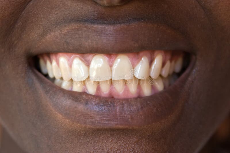 Teeth sample stock photo. Image of anatomy, cavity, prosthesis - 22242958