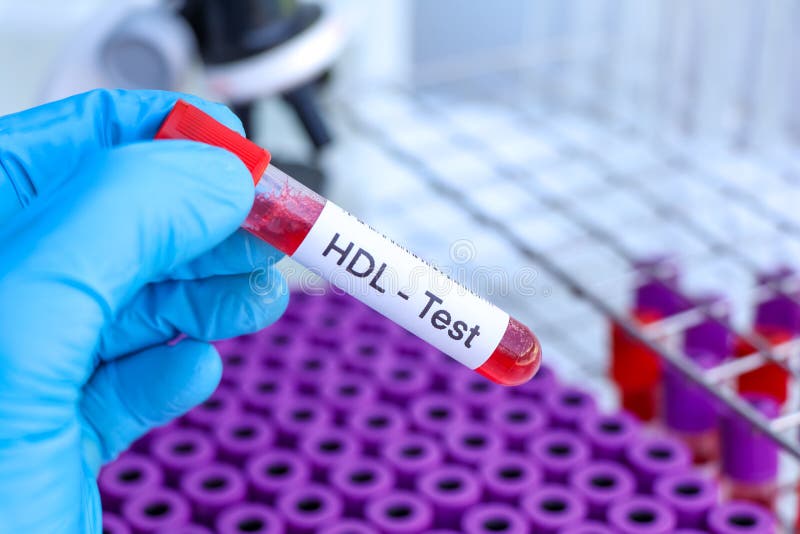 HDL Test To Look for Abnormalities from Blood Stock Image - Image of ...