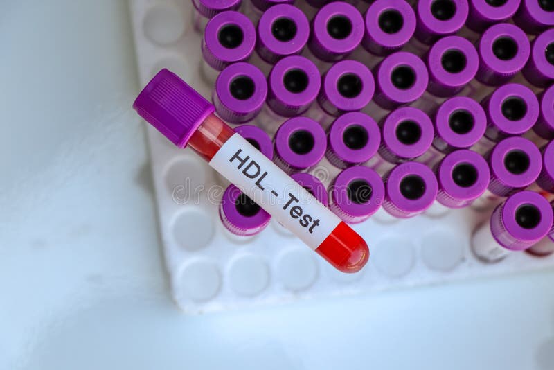 HDL Test To Look for Abnormalities from Blood Stock Image - Image of ...