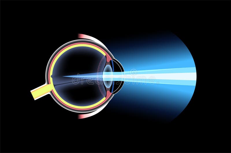 Short Sightedness Refractive Error Stock Illustrations – 44 Short ...