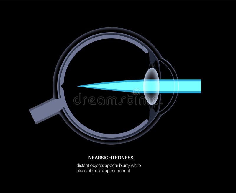Nearsightedness Eye Disease Stock Vector - Illustration of eyeball ...