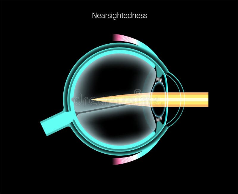 Nearsightedness Eye Disease Stock Vector - Illustration of pupil ...
