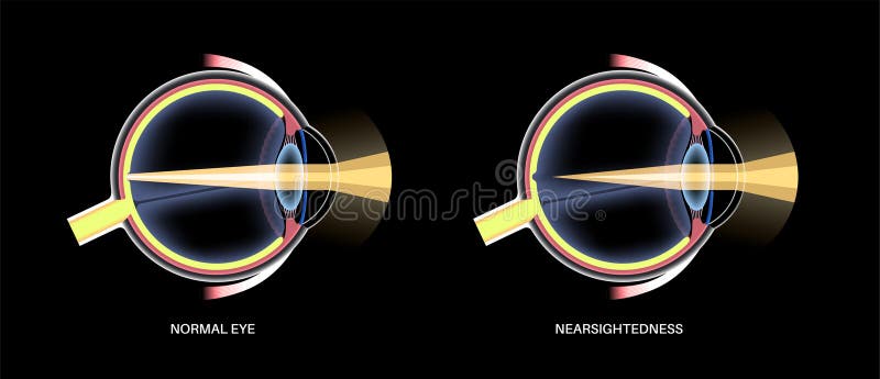 Normal Eye and Nearsightedness Stock Vector - Illustration of ...
