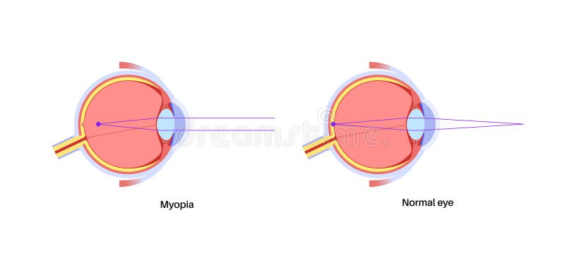 Normal Eye and Nearsightedness Stock Vector - Illustration of cornea ...