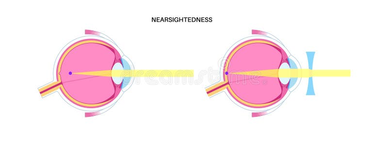 Normal Eye and Nearsightedness Stock Vector - Illustration of cornea ...