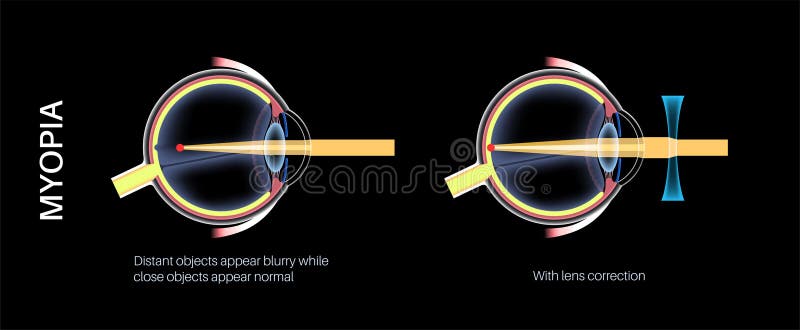 Myopia lens correction stock vector. Illustration of ocular - 354632519