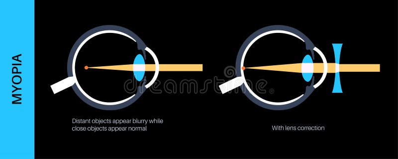 Myopia lens correction stock vector. Illustration of pupil - 356568838