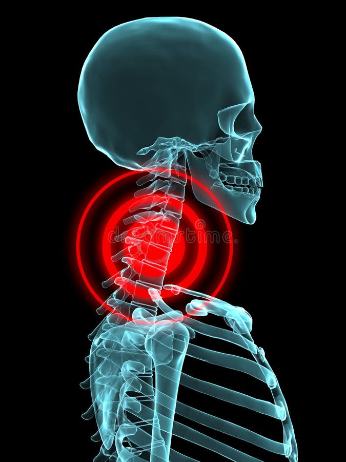 Neck inflammation stock illustration. Illustration of joint - 3658478
