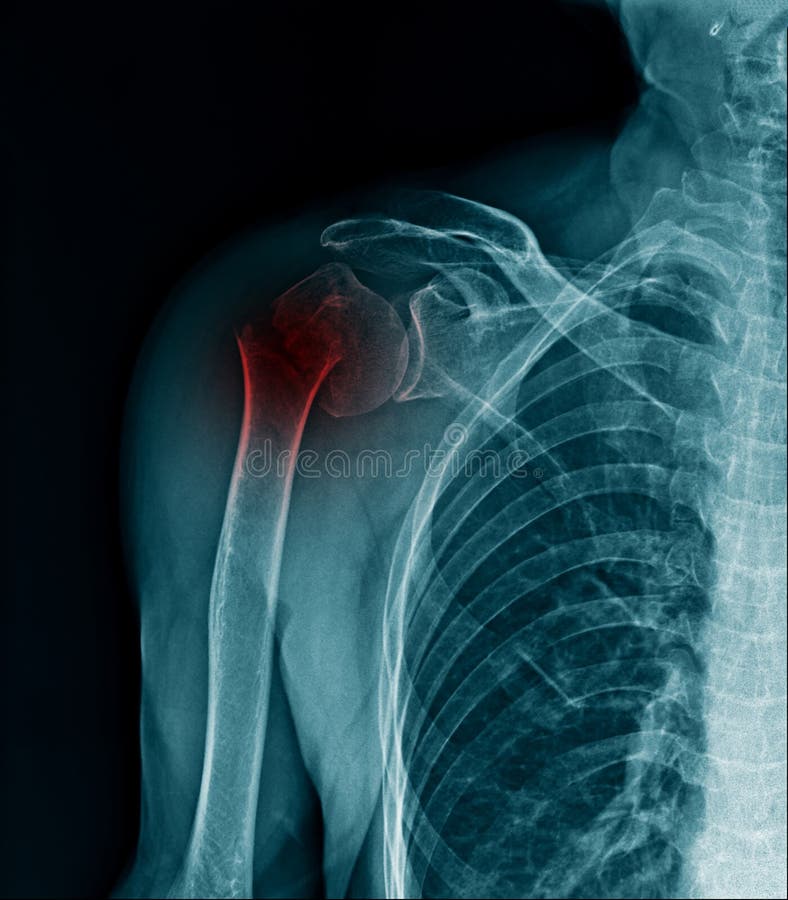 Neck og humerus fracture stock image. Image of room - 148722663