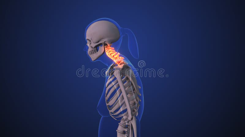 Neck Pain or Neck Dysfunction or Cervical Posture Syndrome Stock ...