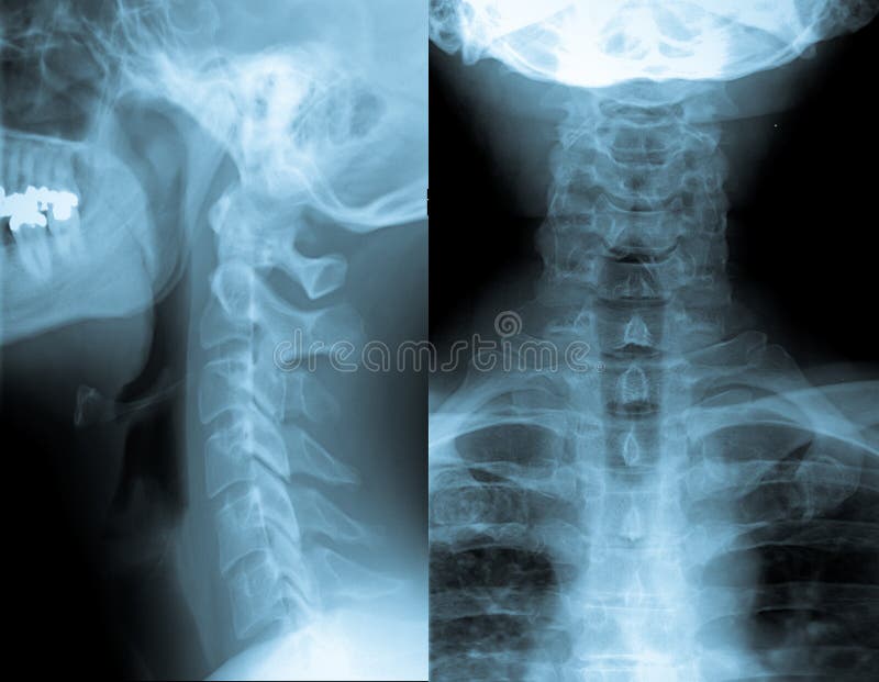 Side X-ray Picture of Head and Neck Stock Image - Image of segment ...