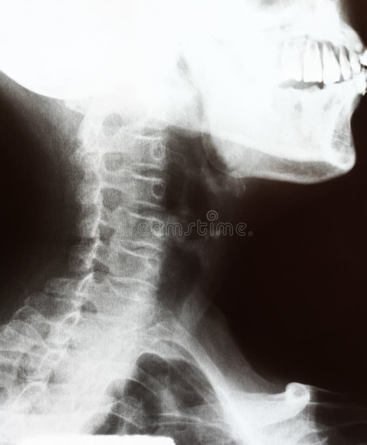 Neck x-ray stock image. Image of throat, negative, neck - 3054901