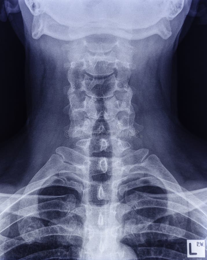 Neck x-ray stock photo. Image of spinal, scan, analyzing - 61970448
