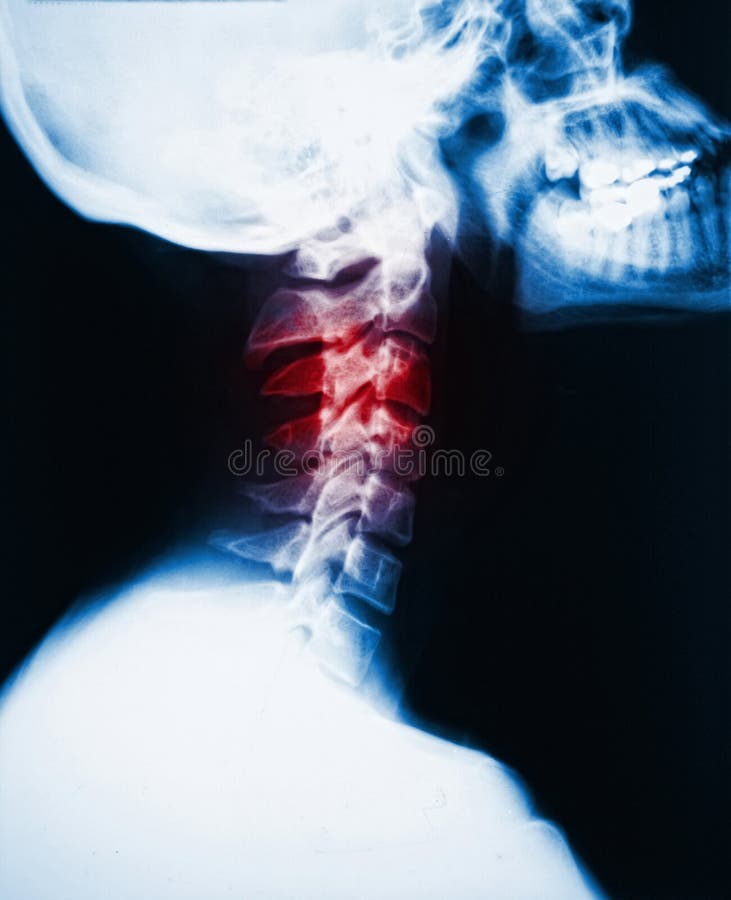 Dislocated Neck X Ray