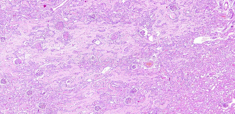 Necrose Cortical Do Rim De Um Ser Humano Imagem de Stock - Imagem de ...