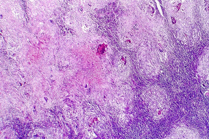 Necrosis Caseosa Del Nodo Linfático Imagen de archivo - Imagen de ...