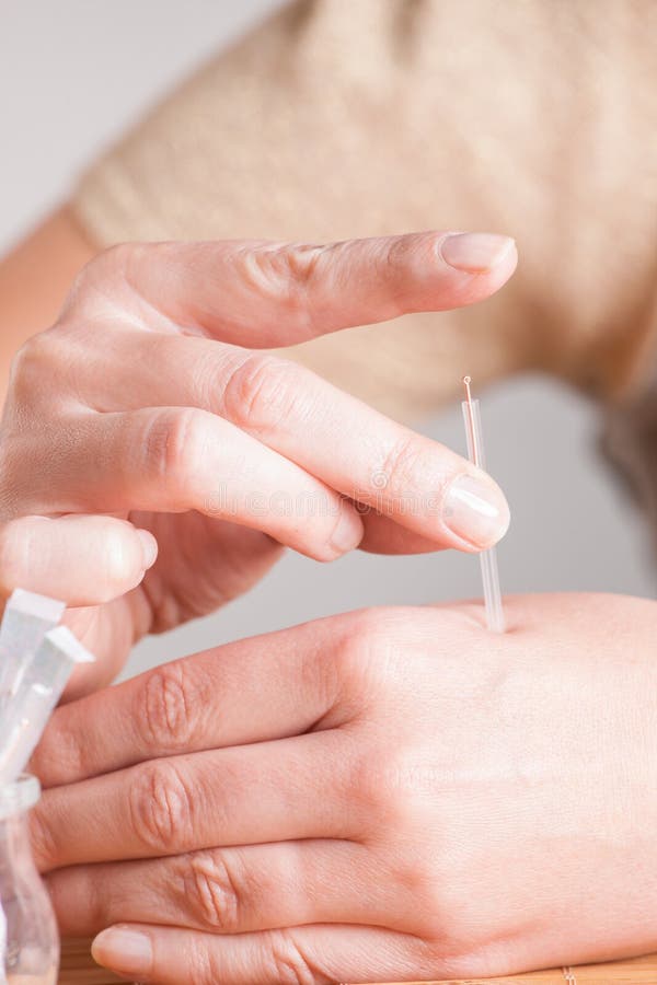Needeling Acupuncture stock photo. Image of hand, energy - 28025602